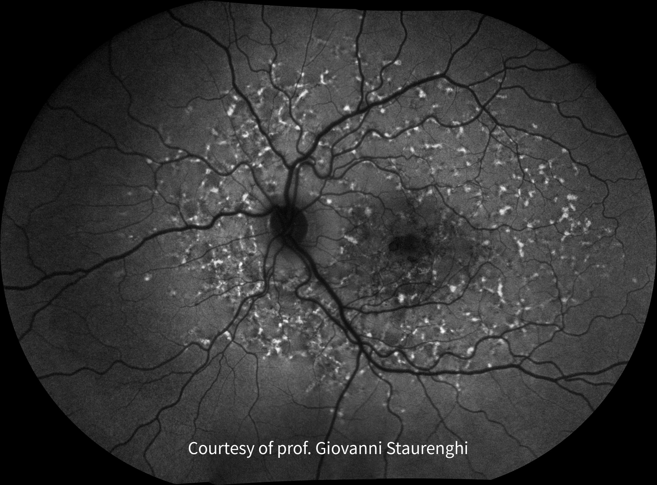 Autofluorescence confocal retinal imager with TrueColor pictures
