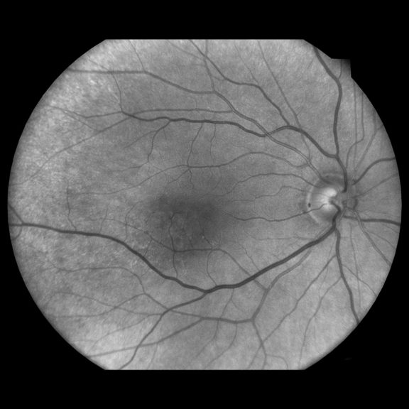 iCare DRSplus TrueColor high-resolution confocal fundus camera