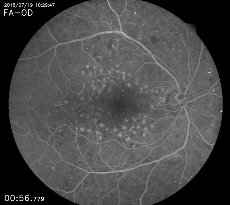 iCare EIDON FA Fluorescein Angiography Confocal Fundus Imaging System