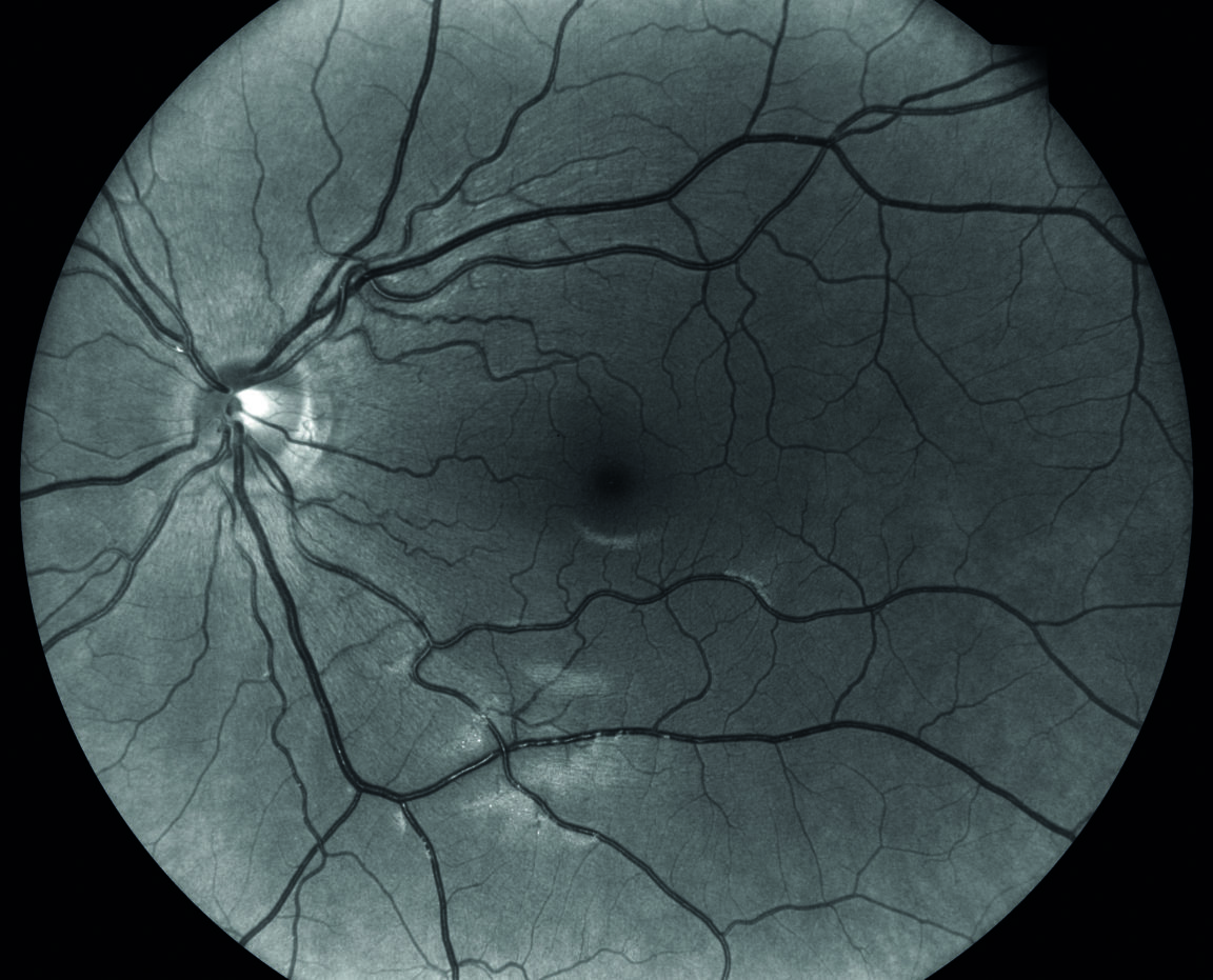 iCare DRSplus Retinal Imaging | iCare Retinal Imaging | TrueColor
